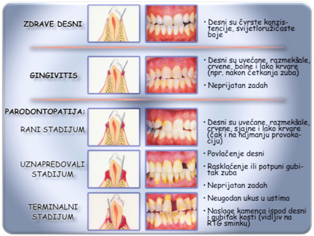 Gingivitisi i Parodontopatije » Javna zdravstvena ustanova Zavod za ...